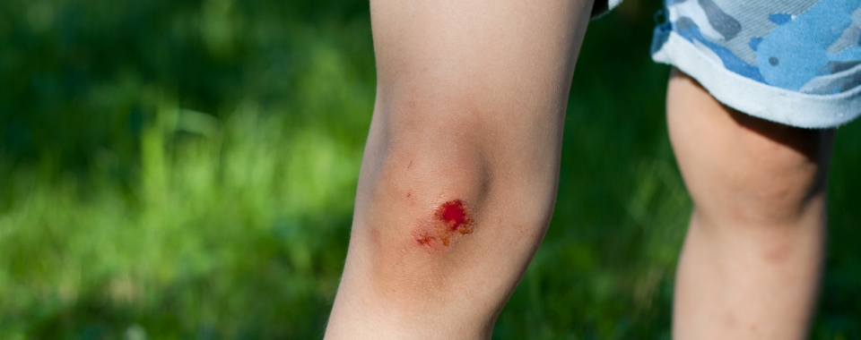 Haavanhoidon ABC: puhidista, suojaa, seuraa - Apteekki